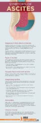 Ascites: Symptoms, Causes & Treatment