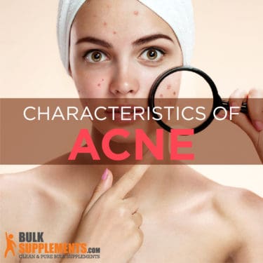 Acne: Characteristics, Causes & Treatment