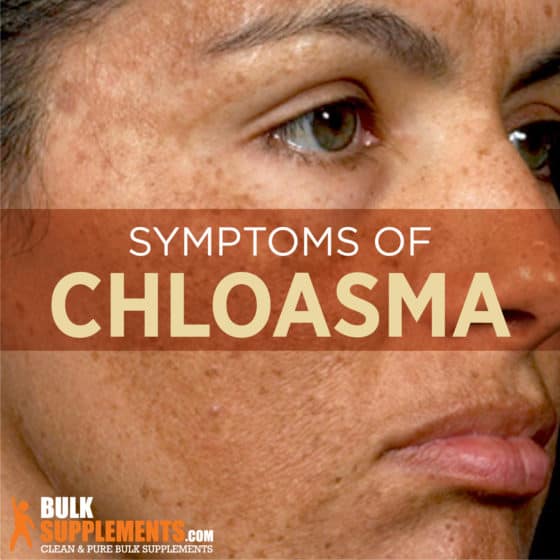 Chloasma: Characteristics, Causes & Treatment