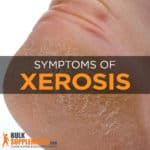 Xerosis (Dry Skin): Symptoms, Causes & Treatment
