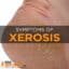 Xerosis (Dry Skin): Symptoms, Causes & Treatment