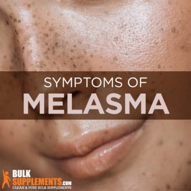Melasma: Symptoms, Causes & Treatment