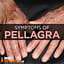 Pellagra: Symptoms, Causes & Treatment