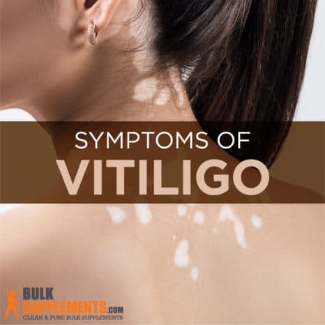 Vitiligo: Symptoms, Causes & Treatment