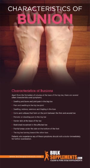 Hallux Valgus (Bunions): Causes, Characteristics & Treatment