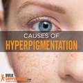 Hyperpigmentation: Symptoms, Causes & Treatment
