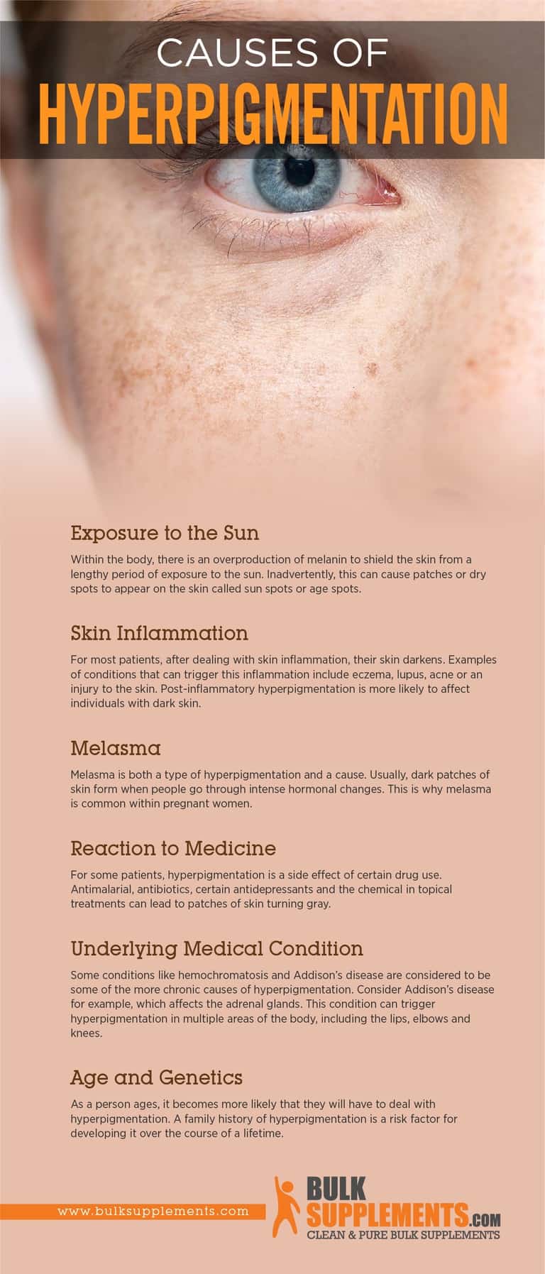 Hyperpigmentation: Symptoms, Causes & Treatment