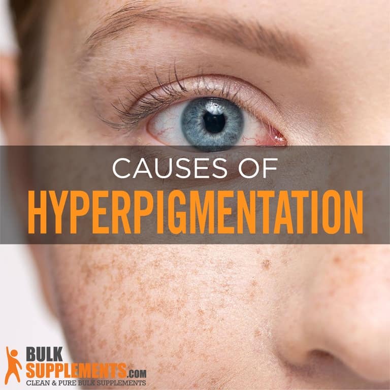 Hyperpigmentation: Symptoms, Causes & Treatment