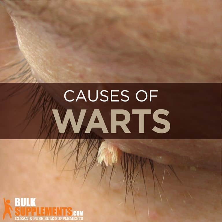 Warts: Causes, Symptoms, Characteristics & Treatment