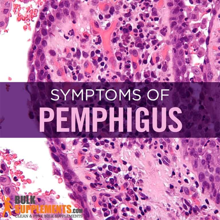 Pemphigus. Don't Suffer. Get Help Managing Symptoms with Supplements