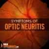 Optic Neuritis: Symptoms, Causes & Treatment