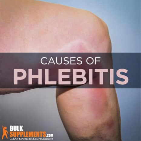 Phlebitis. Get Relief with Treatment and Supplements.