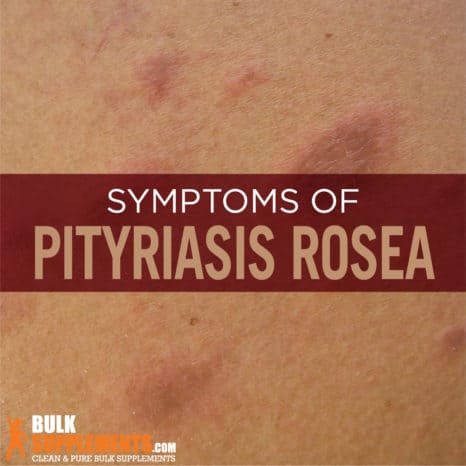 Pityriasis Rosea Causes Picture Symptoms And Treatment