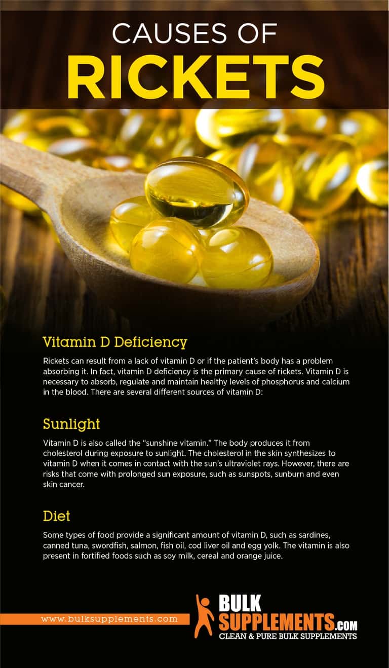 Rickets Causes, Symptoms & Treatment